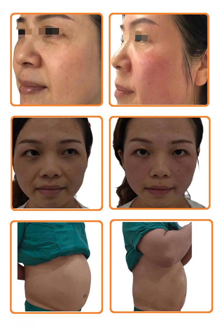 5D Multifunction Rf Body Body Contouring System